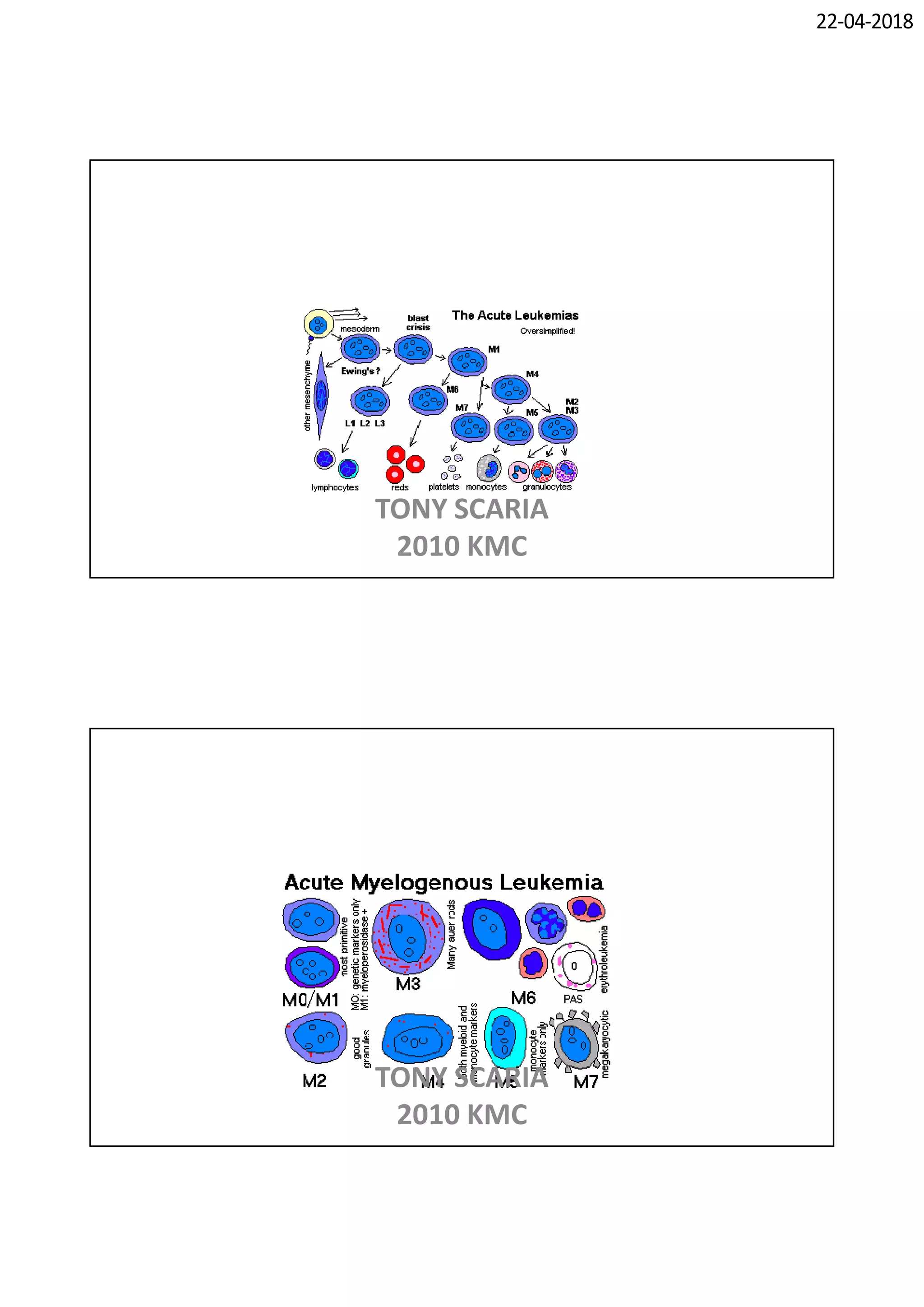 Leukemia and lymphoma PATHOLOGY REVISION NOTES | PDF