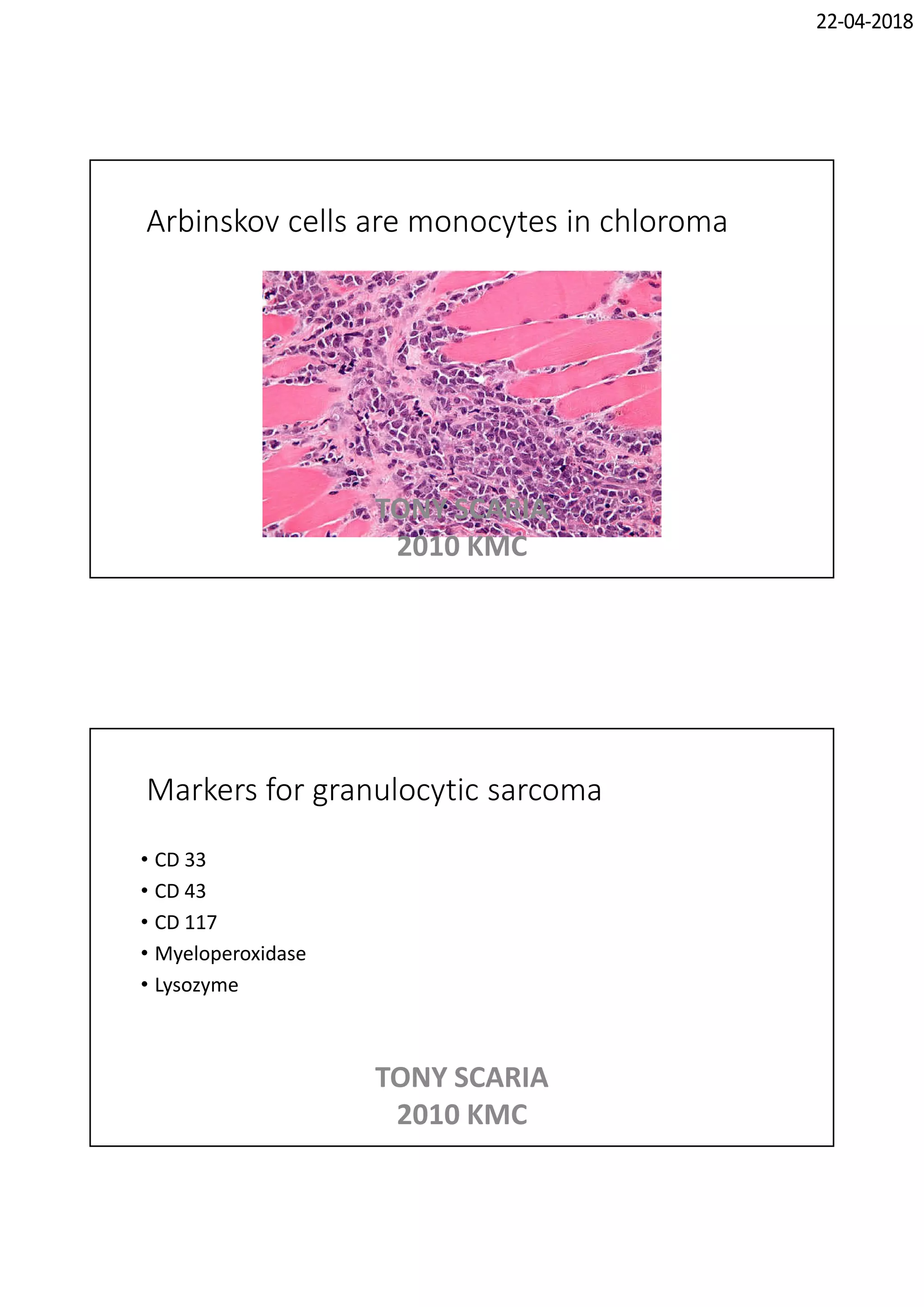 Leukemia and lymphoma PATHOLOGY REVISION NOTES | PDF