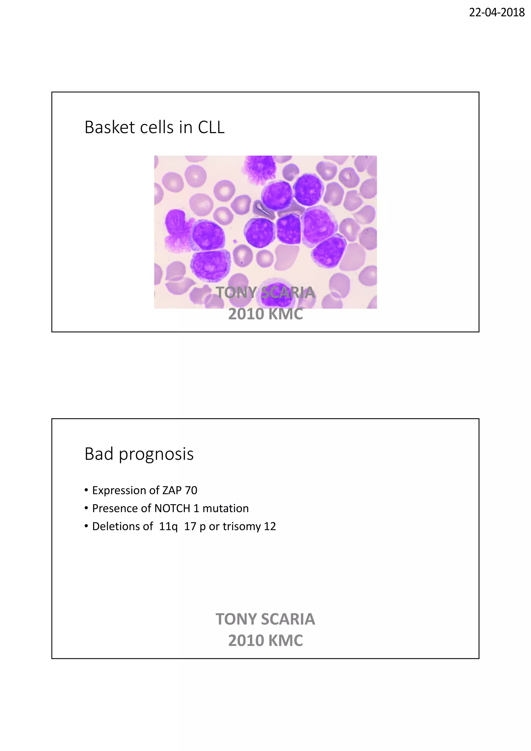 Leukemia and lymphoma PATHOLOGY REVISION NOTES | PDF