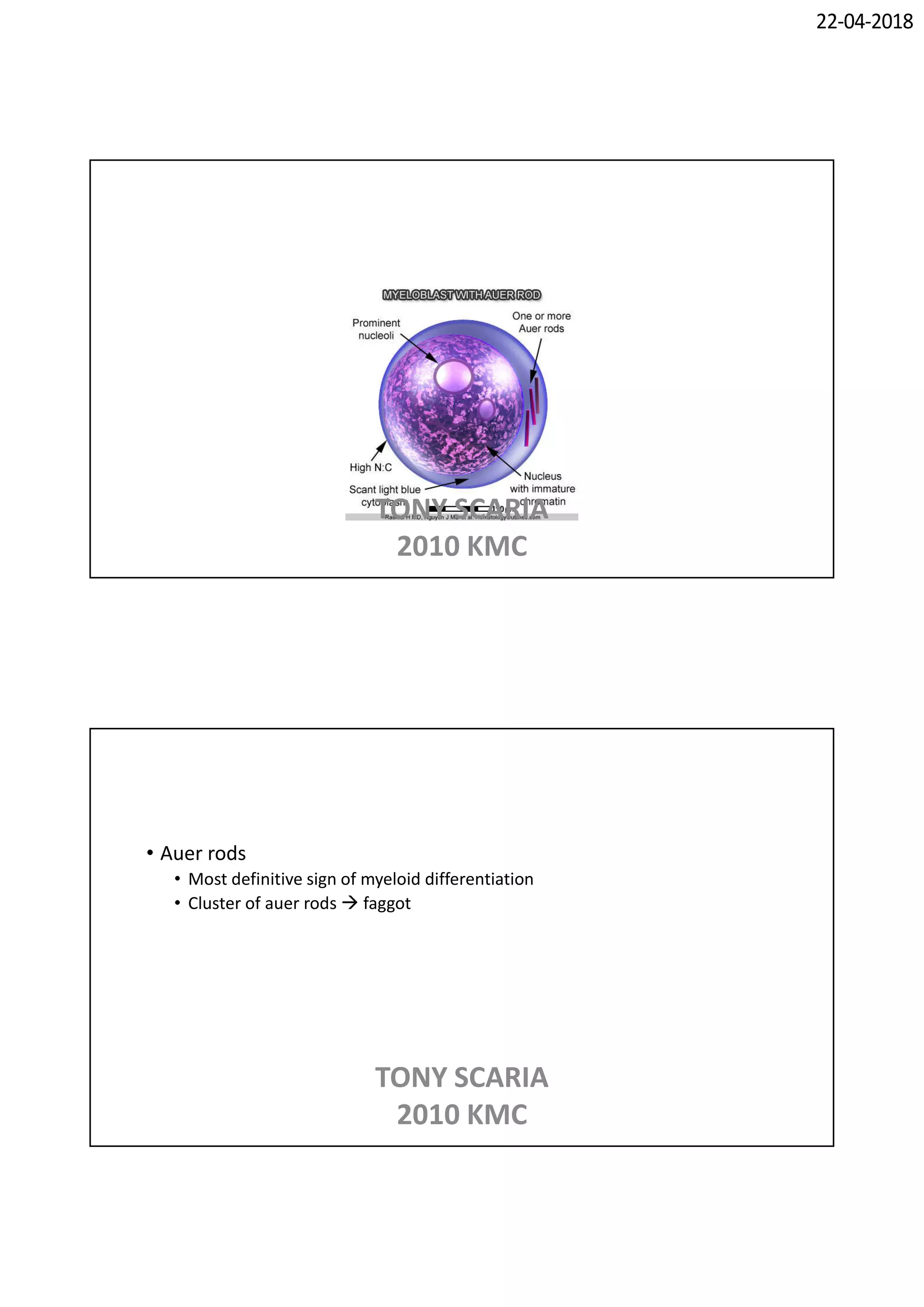 Leukemia and lymphoma PATHOLOGY REVISION NOTES | PDF