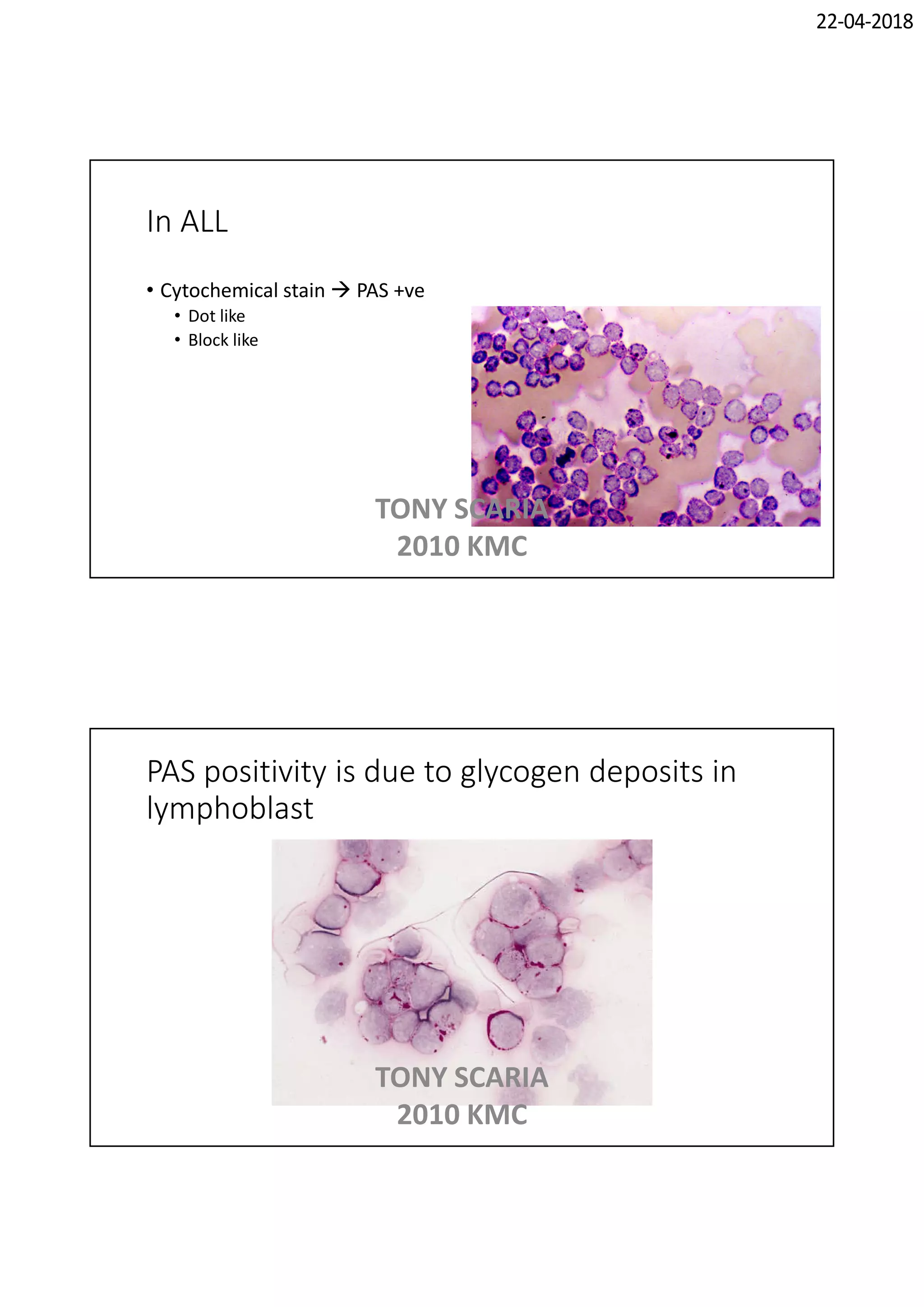 Leukemia and lymphoma PATHOLOGY REVISION NOTES | PDF