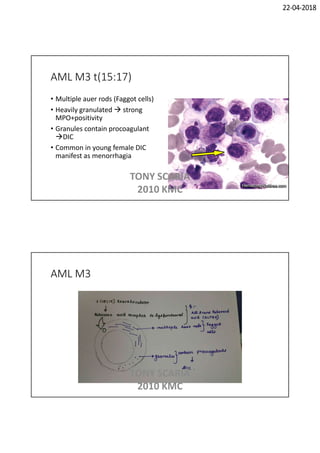Leukemia and lymphoma PATHOLOGY REVISION NOTES | PDF