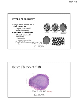 Leukemia and lymphoma PATHOLOGY REVISION NOTES | PDF