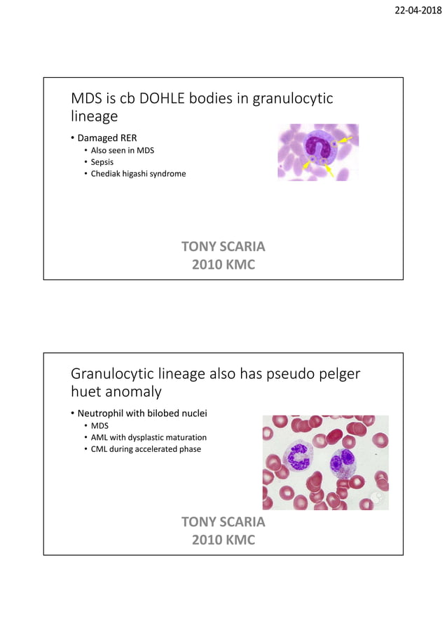 Leukemia and lymphoma PATHOLOGY REVISION NOTES | PDF