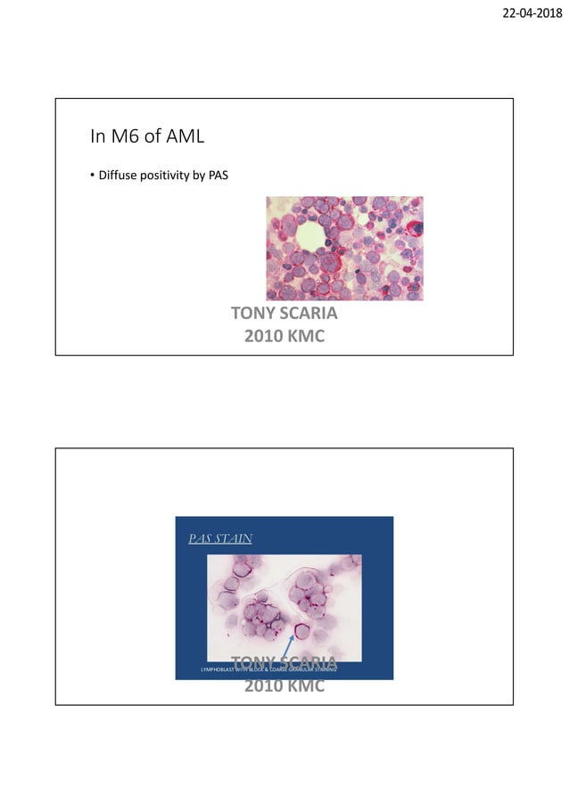 Leukemia and lymphoma PATHOLOGY REVISION NOTES | PDF