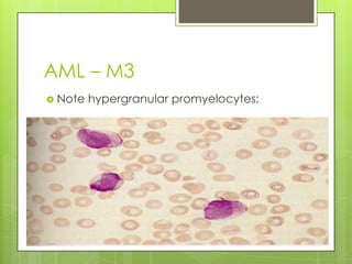 acute and chronic Leukemia therapy by irfan hamid | PPTX