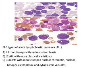 leukemia in children with difference btw all and bll | PPTX