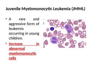 S. Y. G. N. M. CHILD HEALTH NURSING Leukemia in Children.pptx