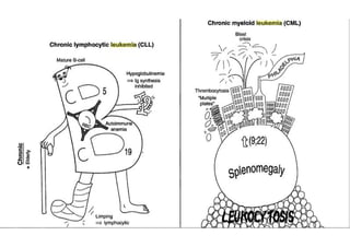 Leukemia visual mnemonics | PDF