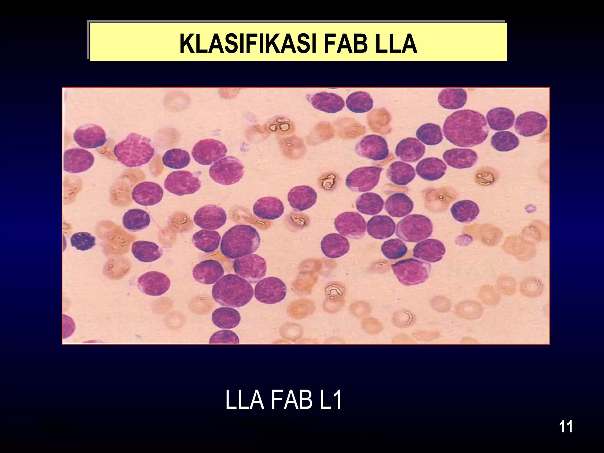 Leukemia pada anak 1 | PPT