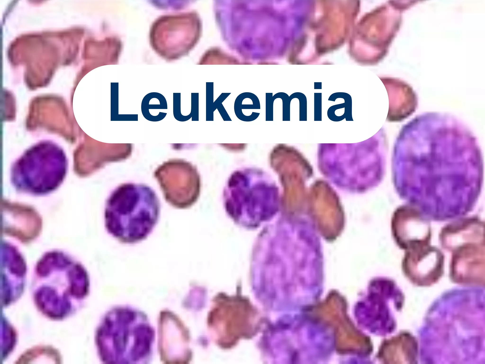 leukemias.ppt