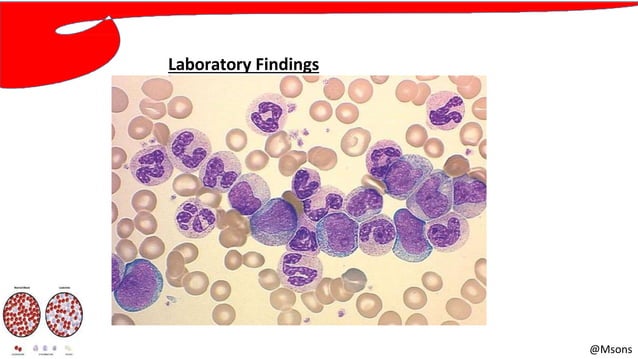 Leukemia slides pathology 4th year mbbs | PPTX | Blood Disorders ...
