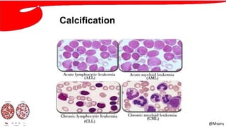 Leukemia slides pathology 4th year mbbs | PPTX