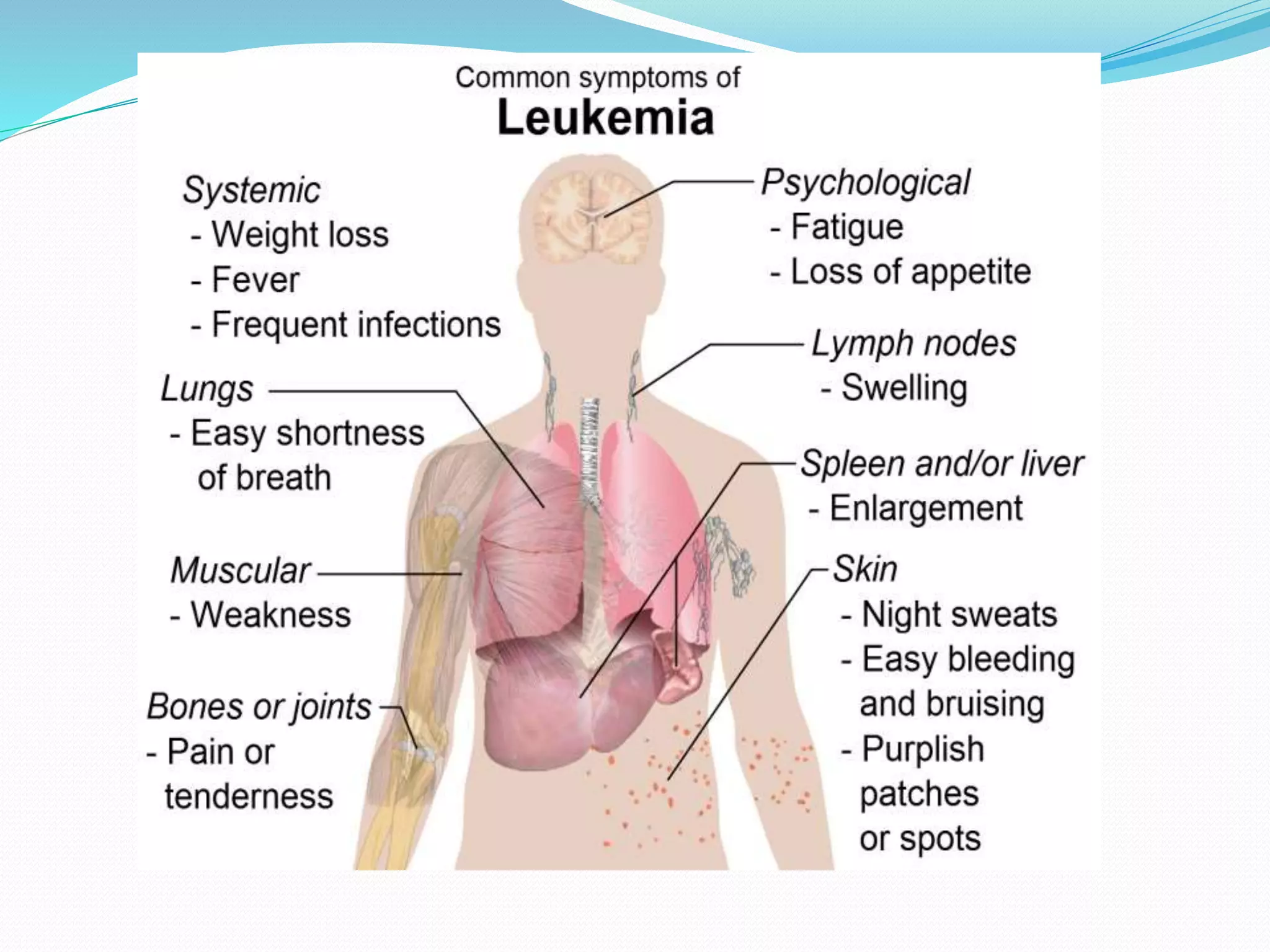 Leukemia | PPTX