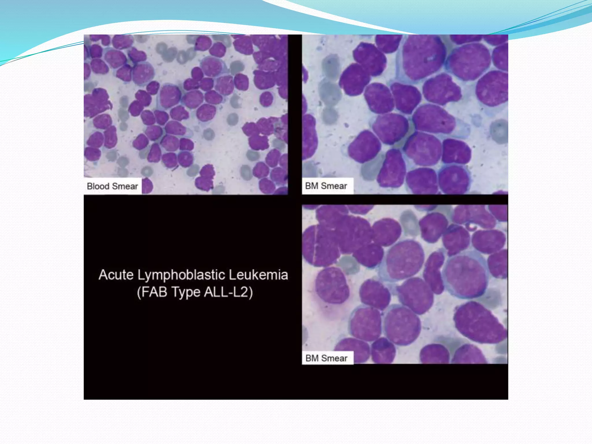 Leukemia | PPTX