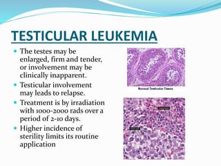 Leukemia | PPTX