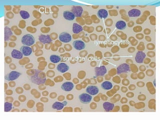 Leukemia | PPTX