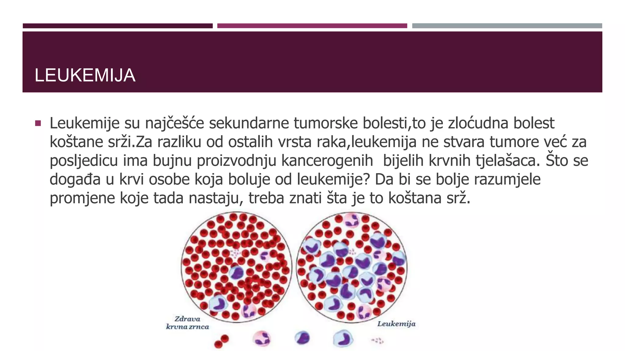 Leukemija | PPTX