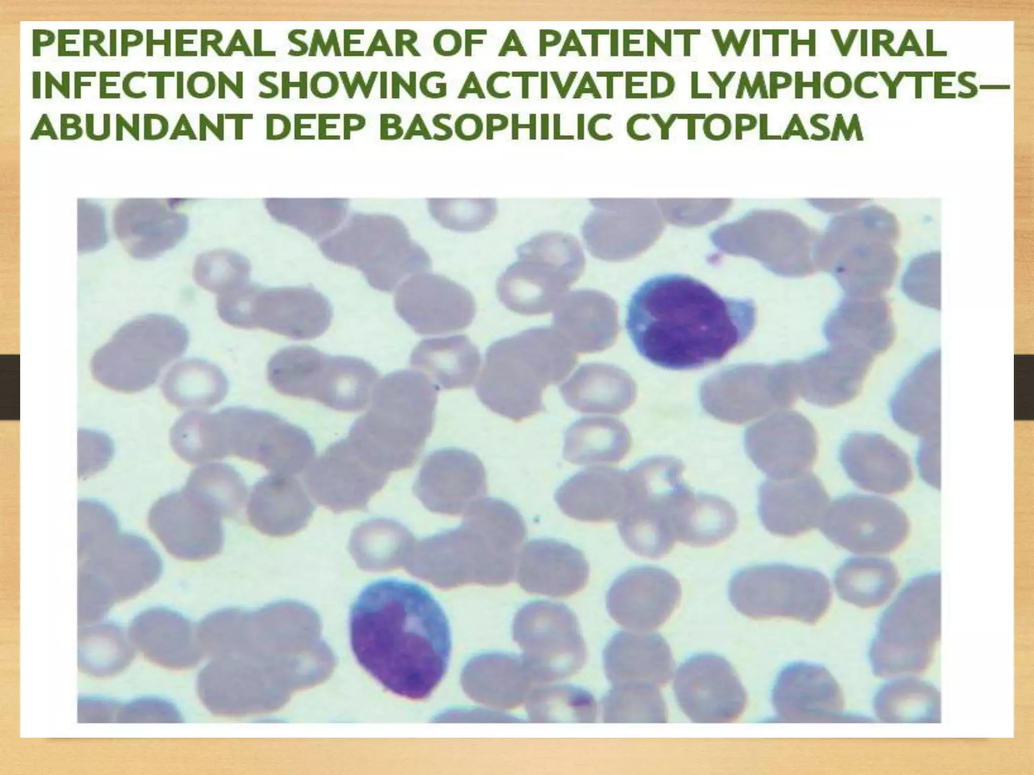 Leukemoid and lekoerythroblastic reaction | PPTX
