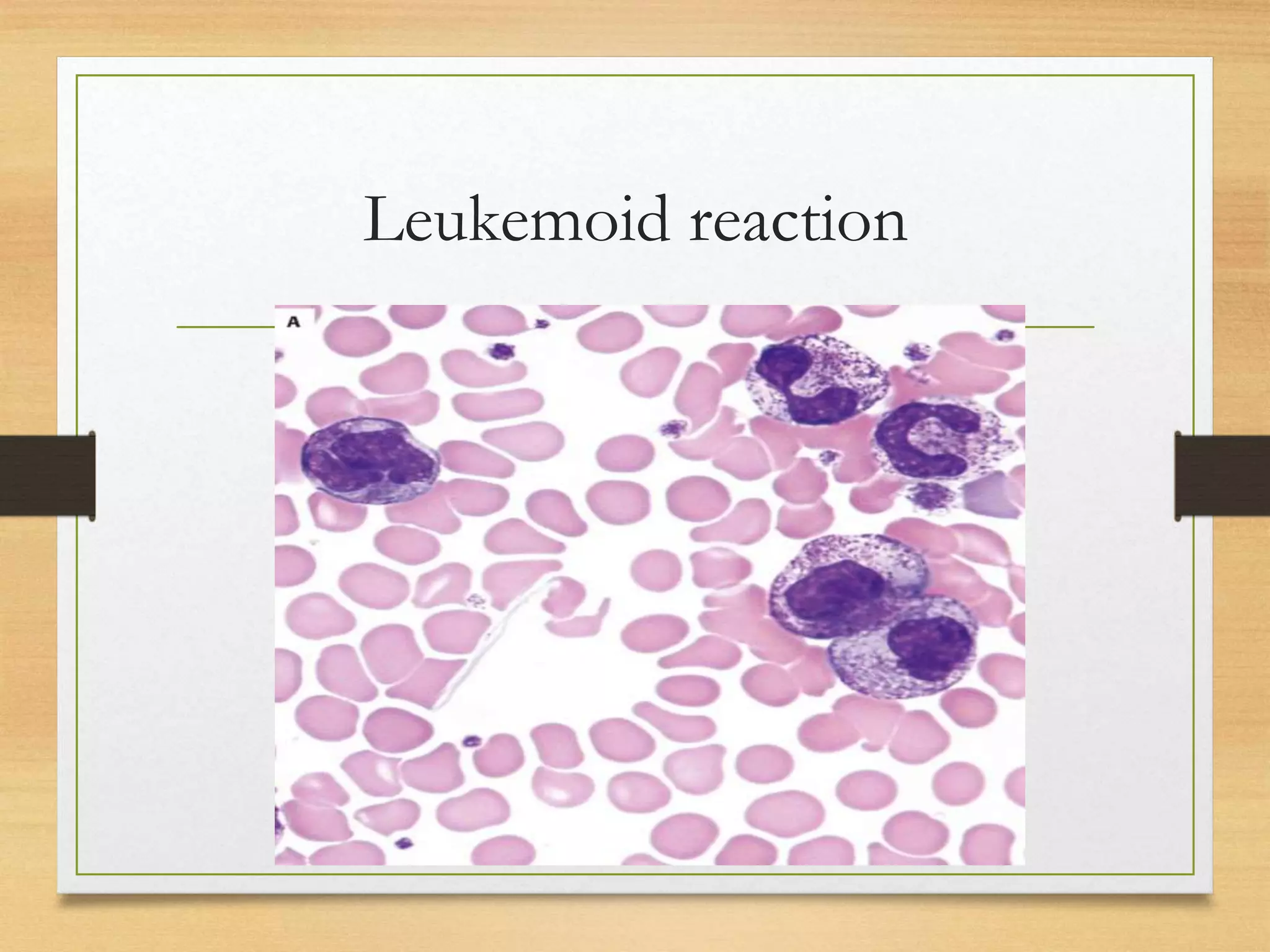 Leukemoid and lekoerythroblastic reaction | PPTX