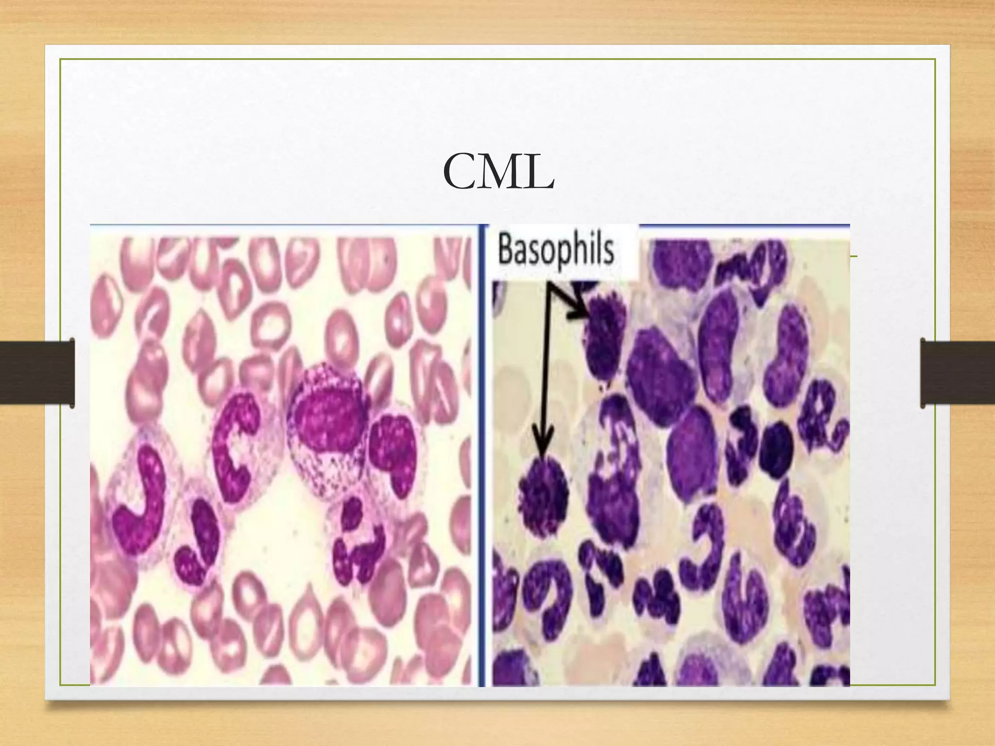Leukemoid and lekoerythroblastic reaction | PPTX