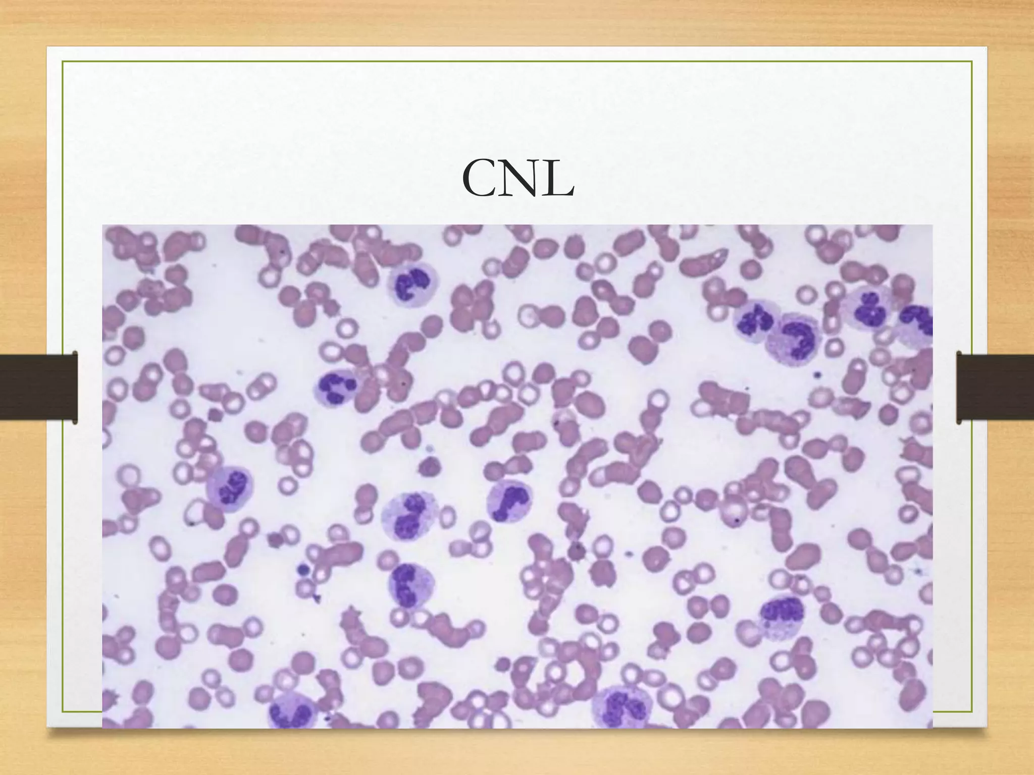 Leukemoid and lekoerythroblastic reaction | PPTX