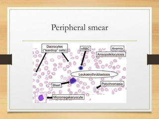 Leukemoid and lekoerythroblastic reaction | PPTX