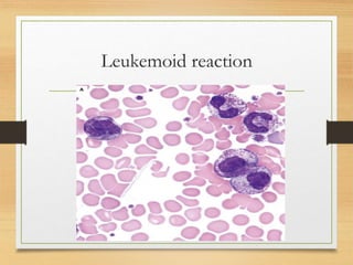 Leukemoid and lekoerythroblastic reaction | PPTX