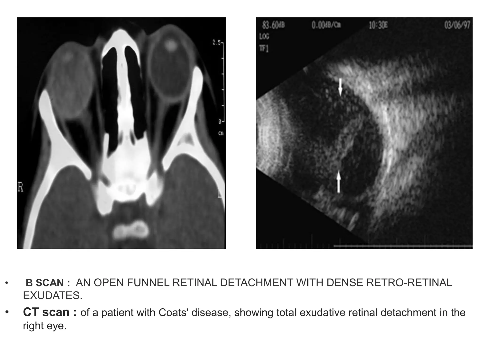 Leukocoria (White Pupillary Reflex) | PPTX