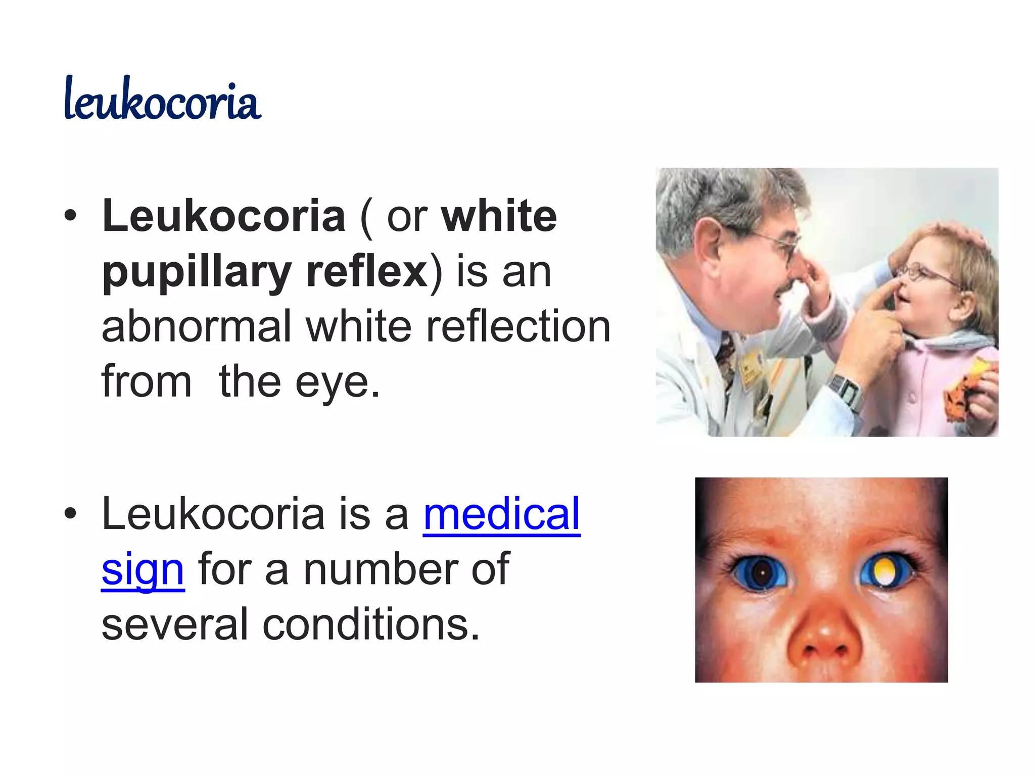Leukocoria (White Pupillary Reflex) | PPTX