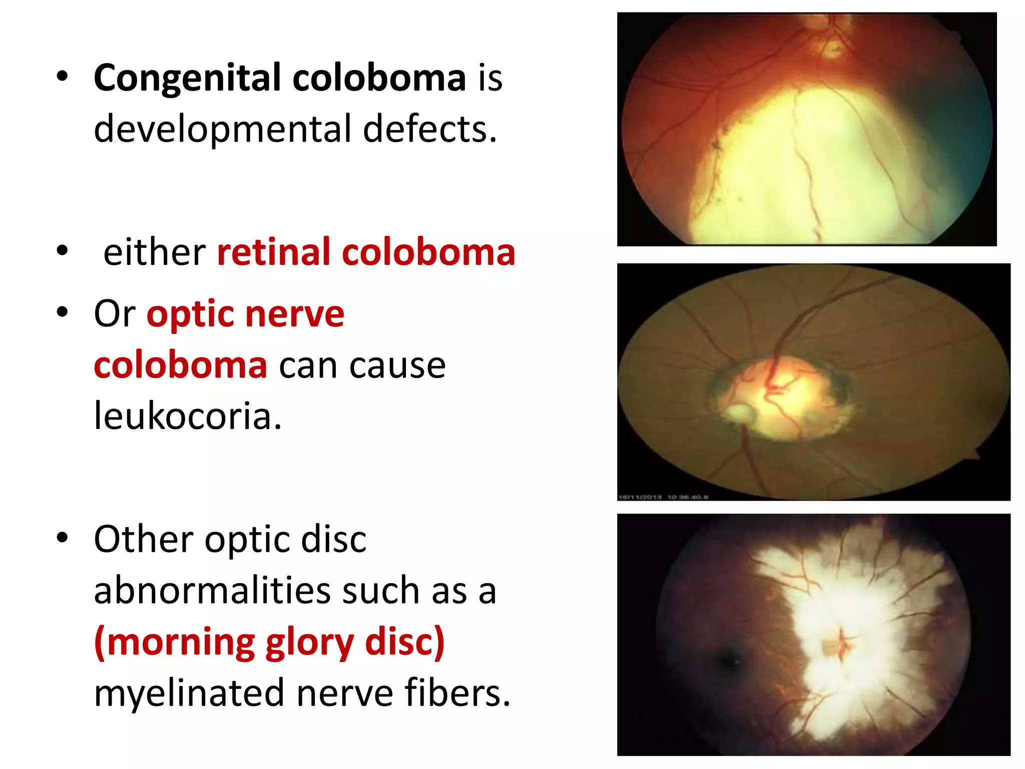 Leukocoria (White Pupillary Reflex) | PPTX