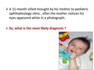 Leukocoria (White Pupillary Reflex) | PPTX