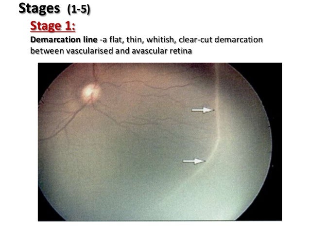 Leukocoria (White Pupillary Reflex)