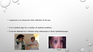LEUKOCORIA causes ,risk factors and treatment.pptx