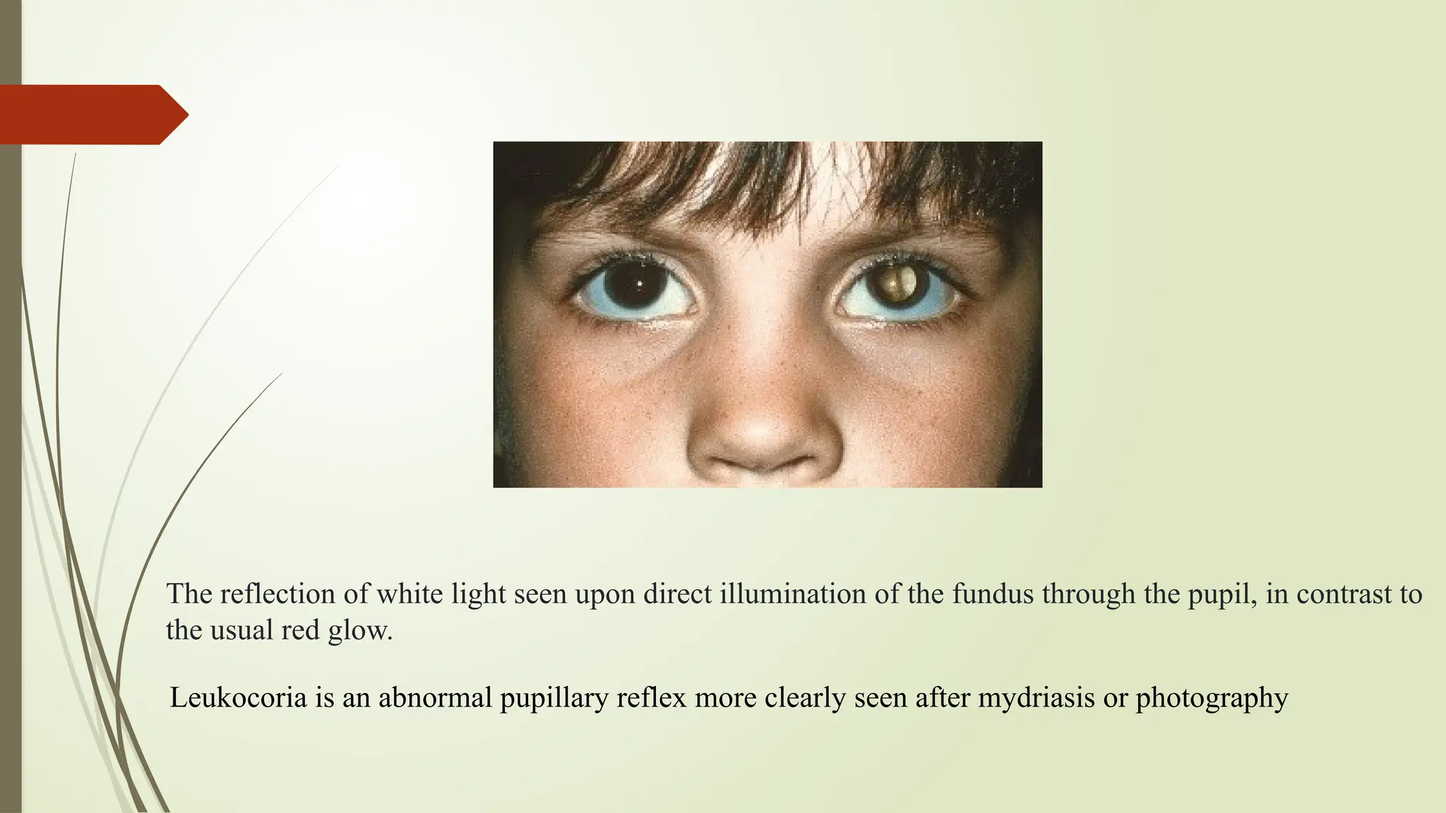 Leukocoria in children in ophthalmology. | PPTX