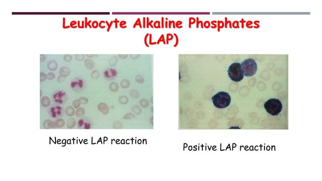Leukocyte Alkaline Phosphatase Stain