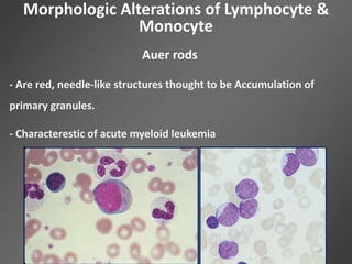 Reactive Lymphocytes Vs Monocytes
