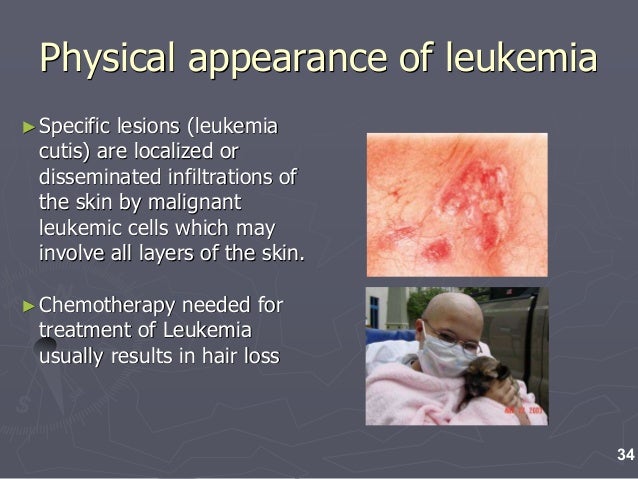 Leukocytosis