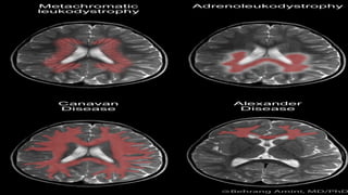 Leukodystrophies | PDF