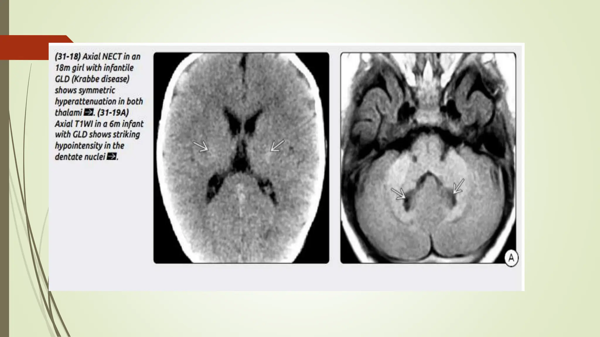 LEUKODYSTROPHY FINAL.pptx sms medical jaipur | PPT