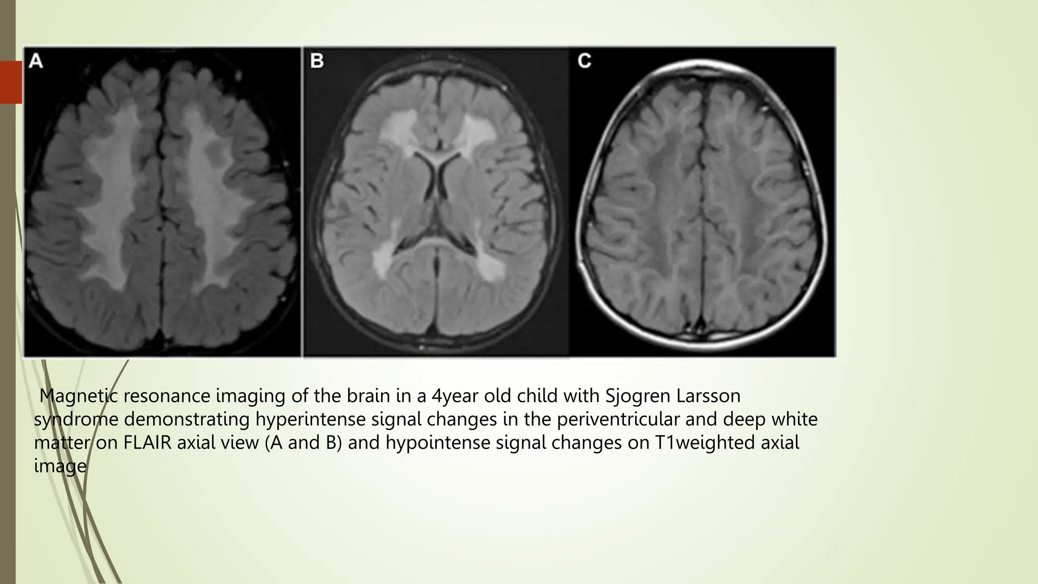 LEUKODYSTROPHY FINAL.pptx sms medical jaipur | PPT