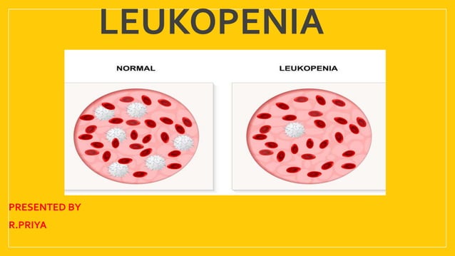 Leukopenia | PPTX | Blood Disorders | Diseases and Conditions