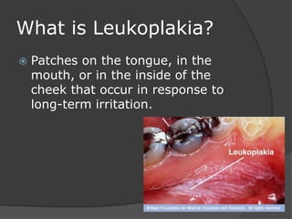 Leukoplakia | PPTX