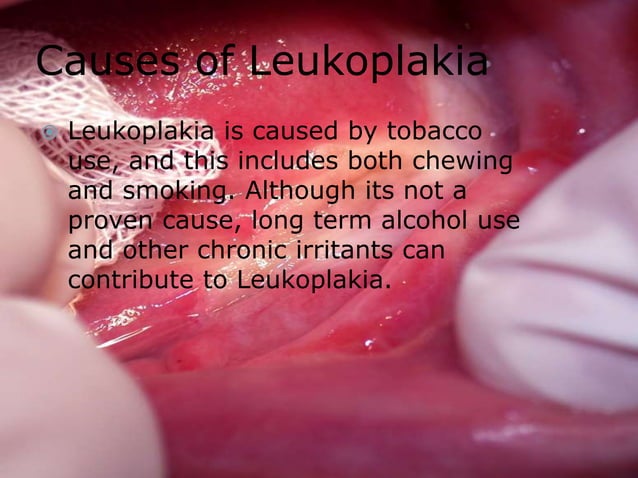 Leukoplakia | PPTX