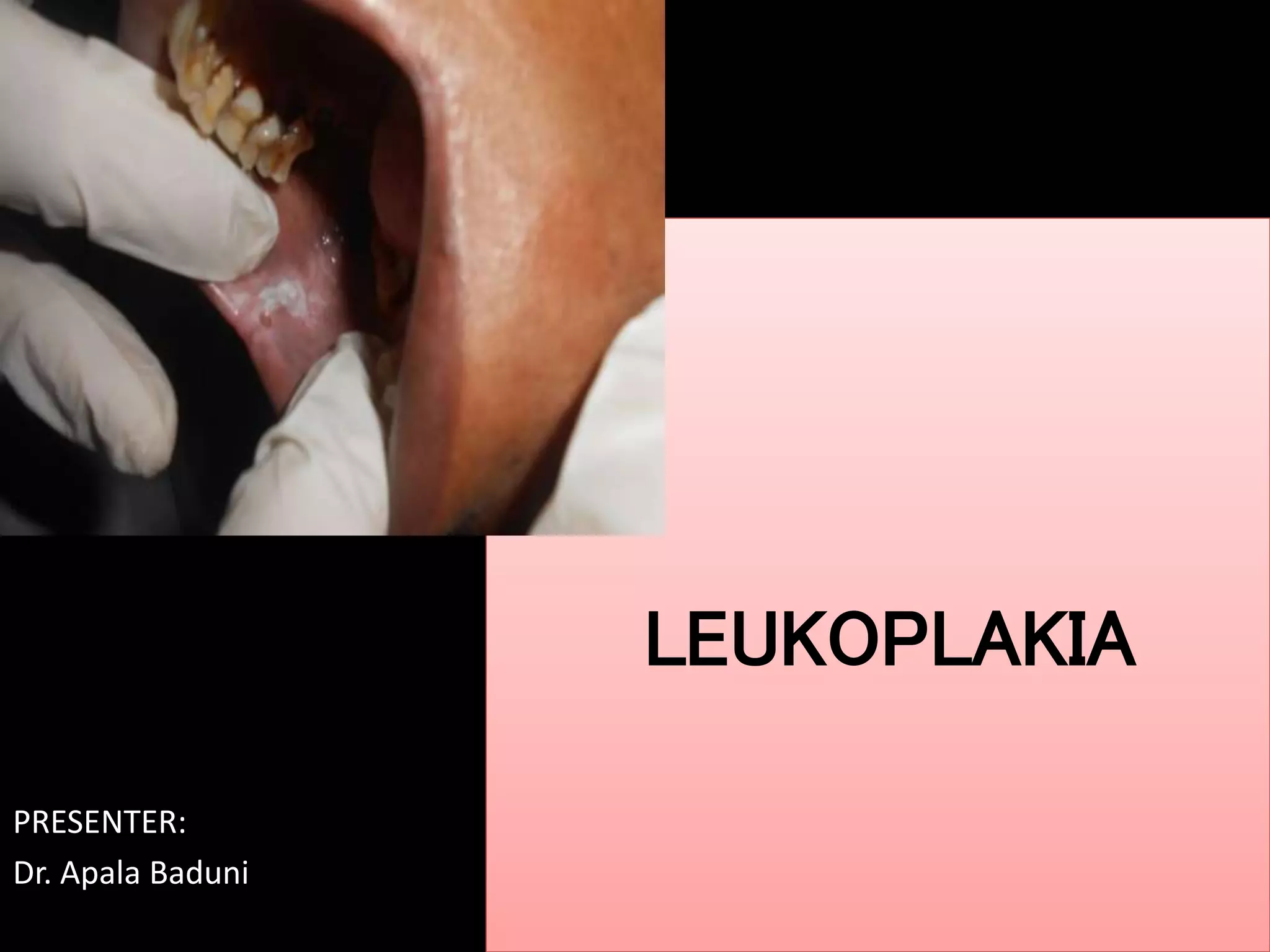Leukoplakia | PPTX