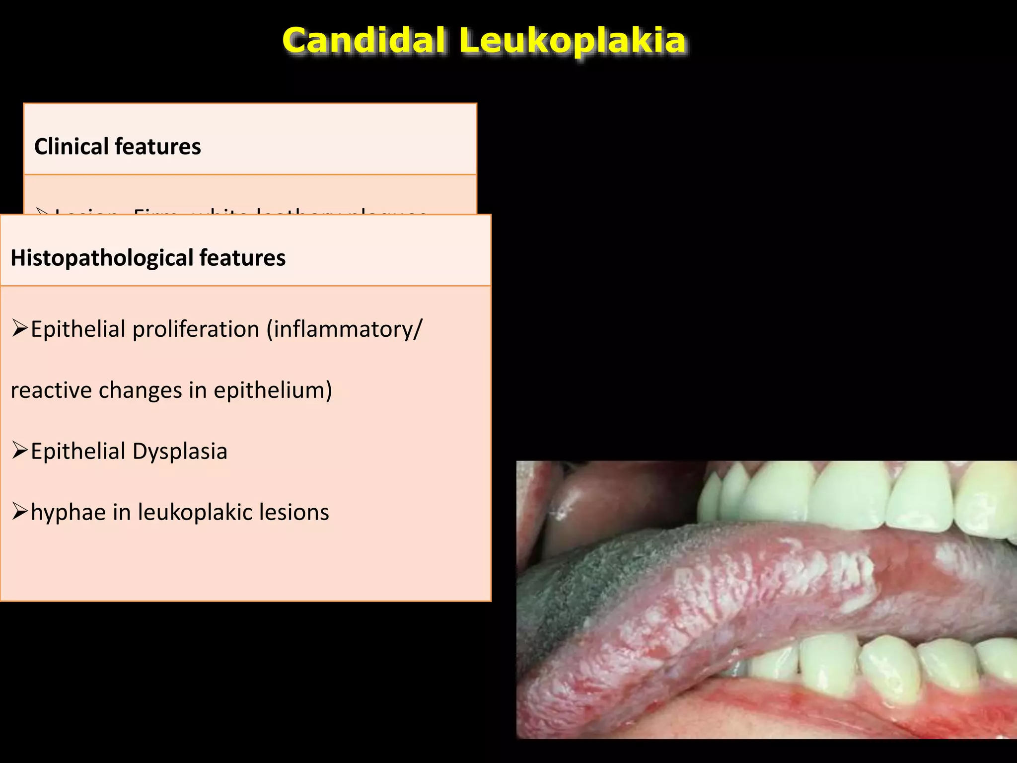 Leukoplakia | PPTX