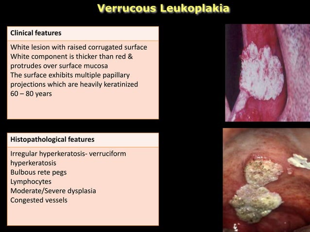 Leukoplakia | PPTX | Dental Health | Diseases and Conditions
