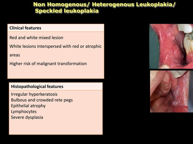 Leukoplakia | PPTX | Dental Health | Diseases and Conditions