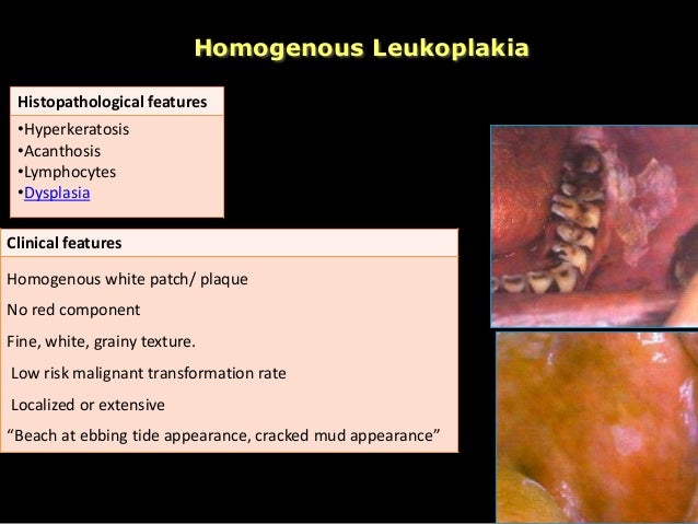 Leukoplakia