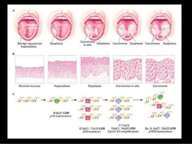 Leukoplakia